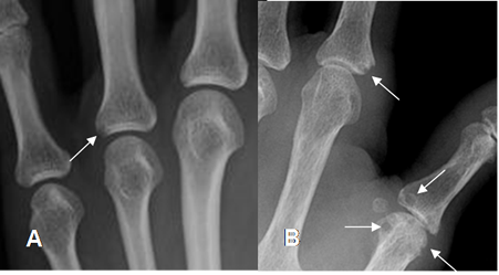 Fig 21. Artropatía reumática.