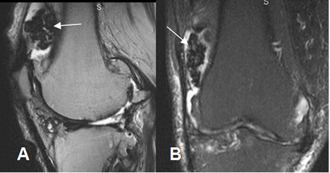 Fig 49. Sinovitis villonodular pigmentaria.