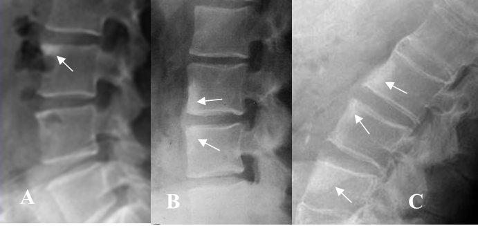 Fig 59 A. Lesiones Romanus.