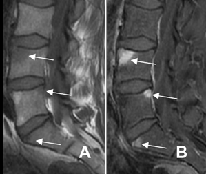Fig 59 D. Lesiones Romanus.