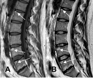 Fig 59 E. Lesiones Romanus.