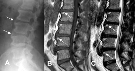 Fig 59 F. Espondilitis anquilosante.